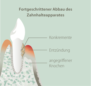 Parodontologie - Zahnarzt Berlin-Charlottenburg am Savignyplatz Dr ...